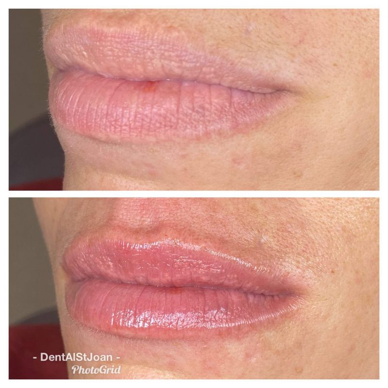 Armonización orofacial - Dent Al, clínica dental Sant Joan Despí